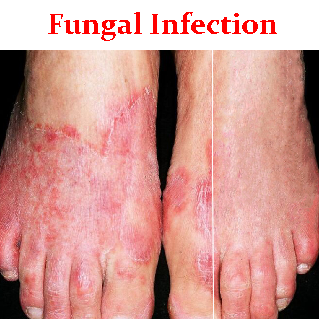 Fungal Infection Product Box Sharma Pharmacy fungal-infection-product-box-sharma-pharmacy
